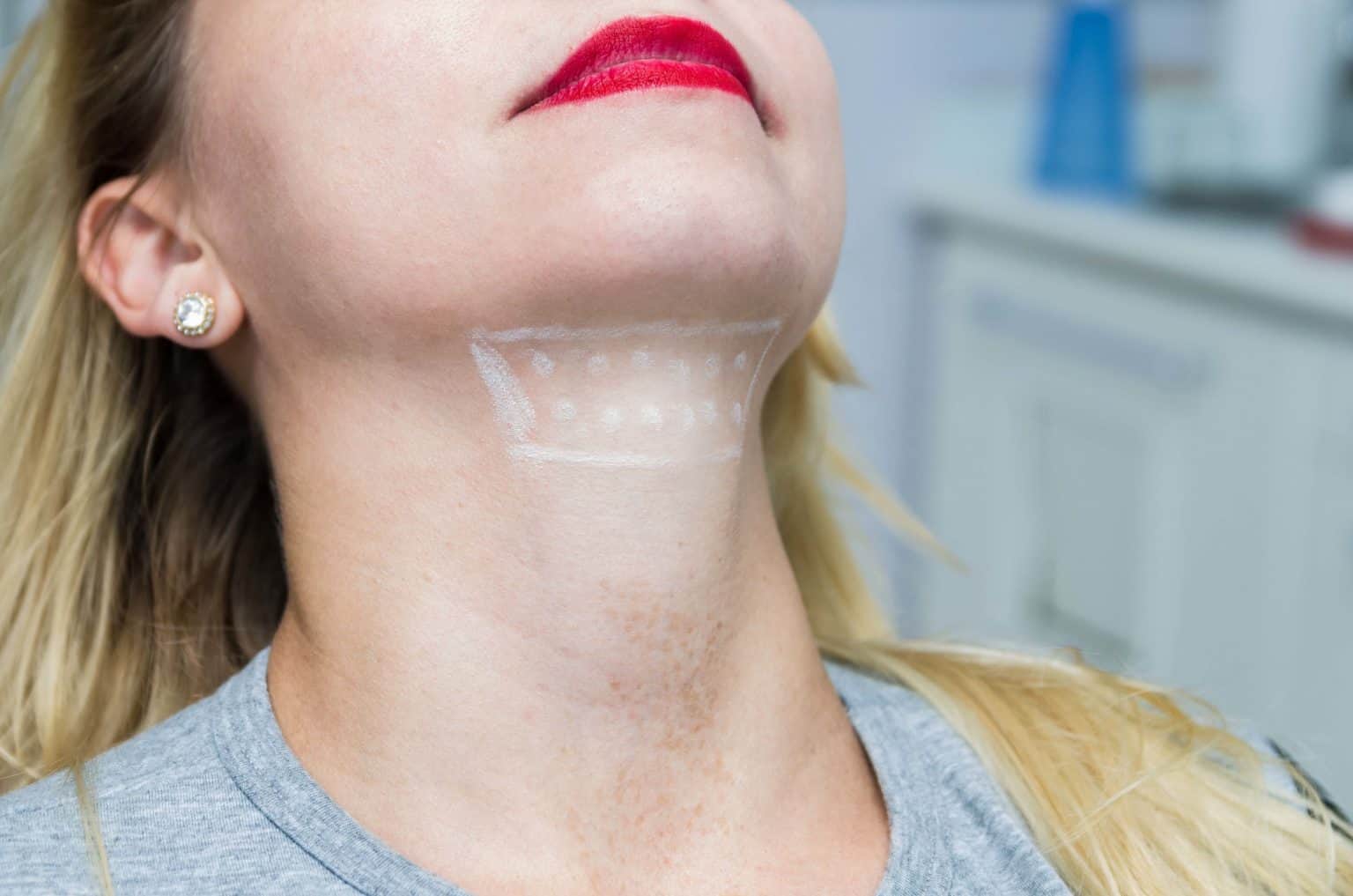 How Much Time Is There Between Kybella Treatments?